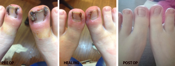 3 Weeks After Toenail Removal | Dr. Archit Aggarwal