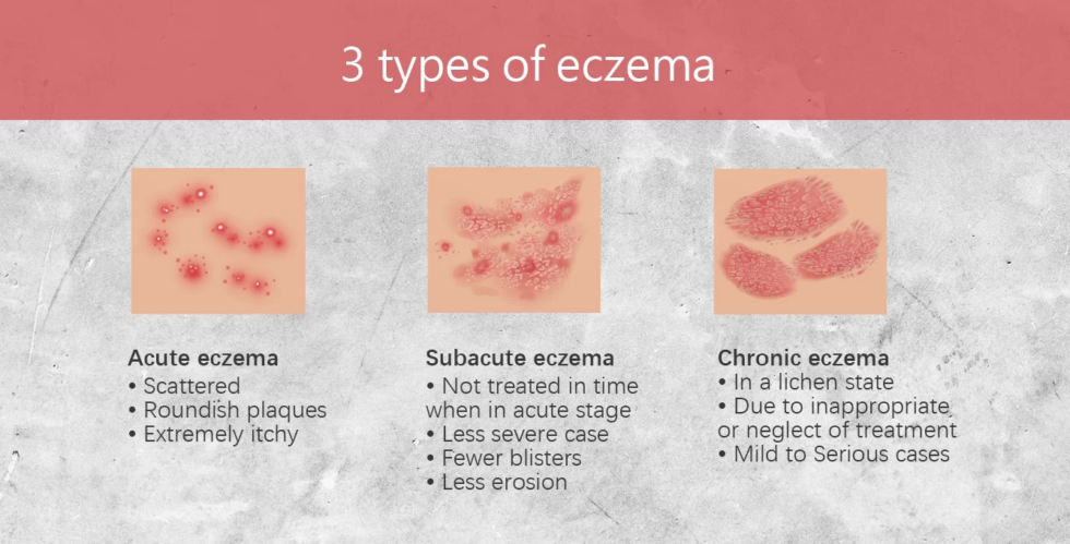 How to Tell If Eczema is Healing | Dr. Archit Aggarwal